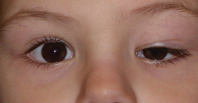 Paediatric Eye Conditions – Ptosis – THONEH Paediatric Eye Conditions – Ptosis – THONEH